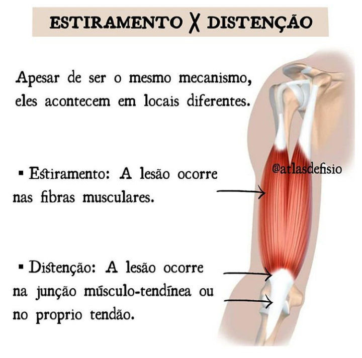 Diferença de estiramento e distensao - Fisioterapia Ortopédica