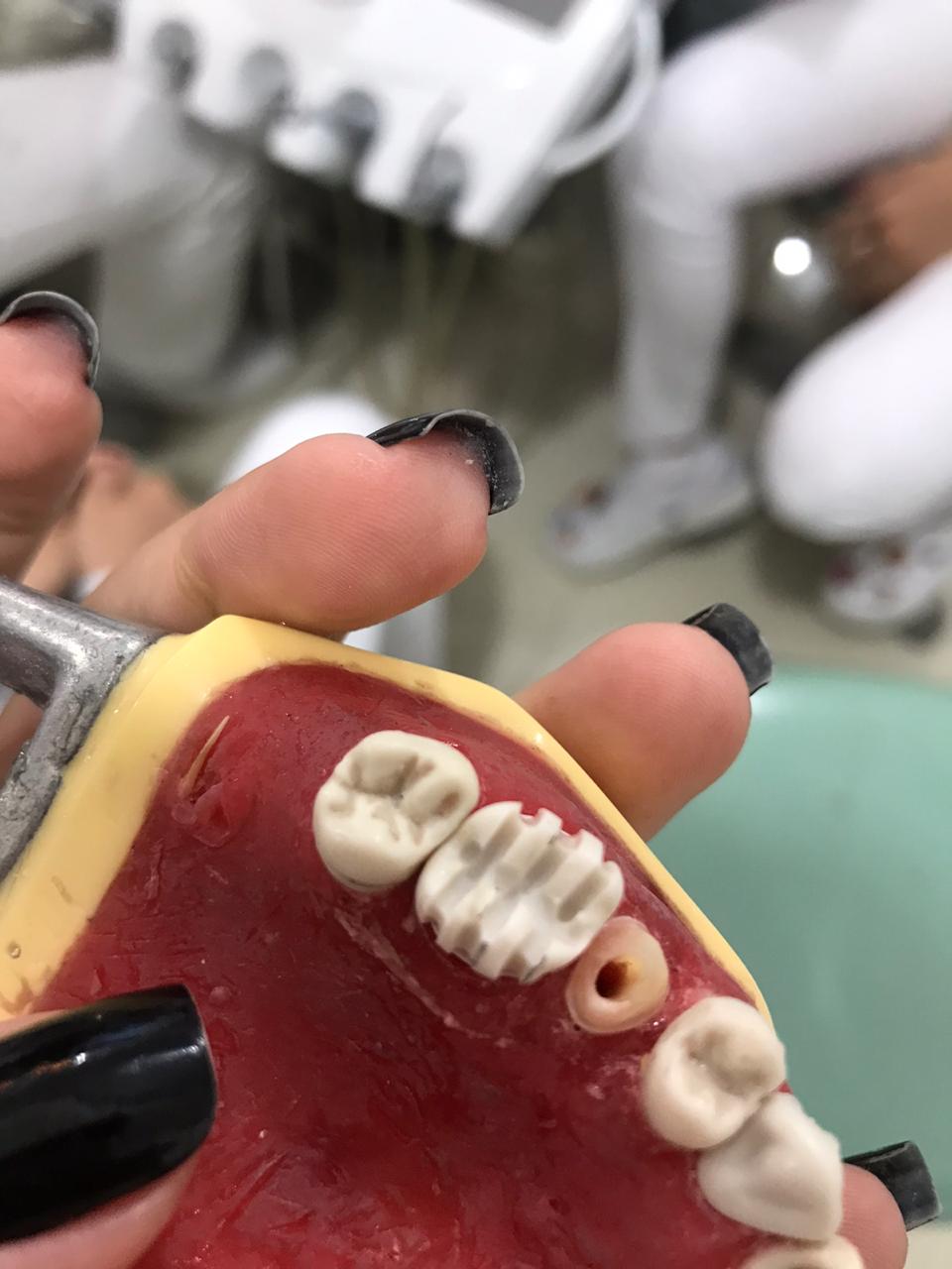 preparo pt fixa molar - Prótese Parcial Fixa Pré-clínica