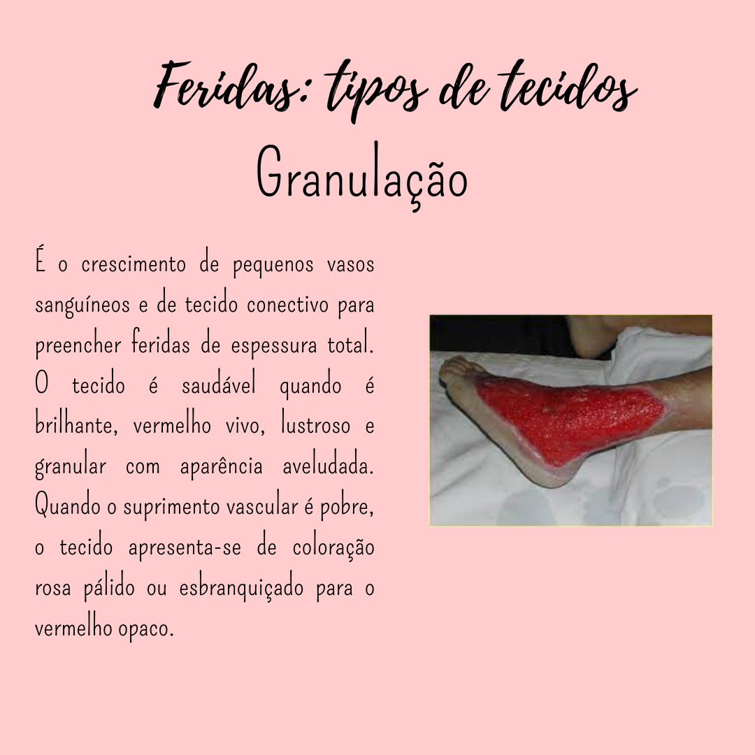 Tecido com granulação - Enfermagem
