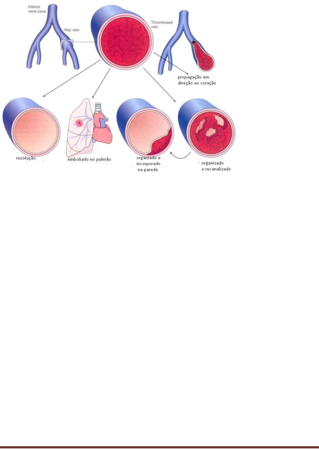 TROMBOSE - Patologia I