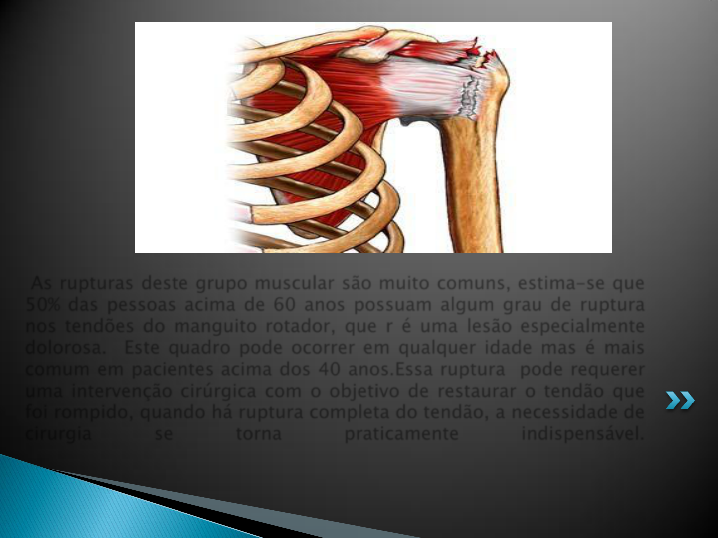 Ruptura do manguito rotador do ombro - Ortopedia