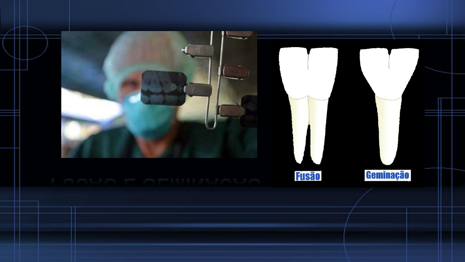 Seminário de Radiologia PDF (Fusao e geminação) - Radiologia