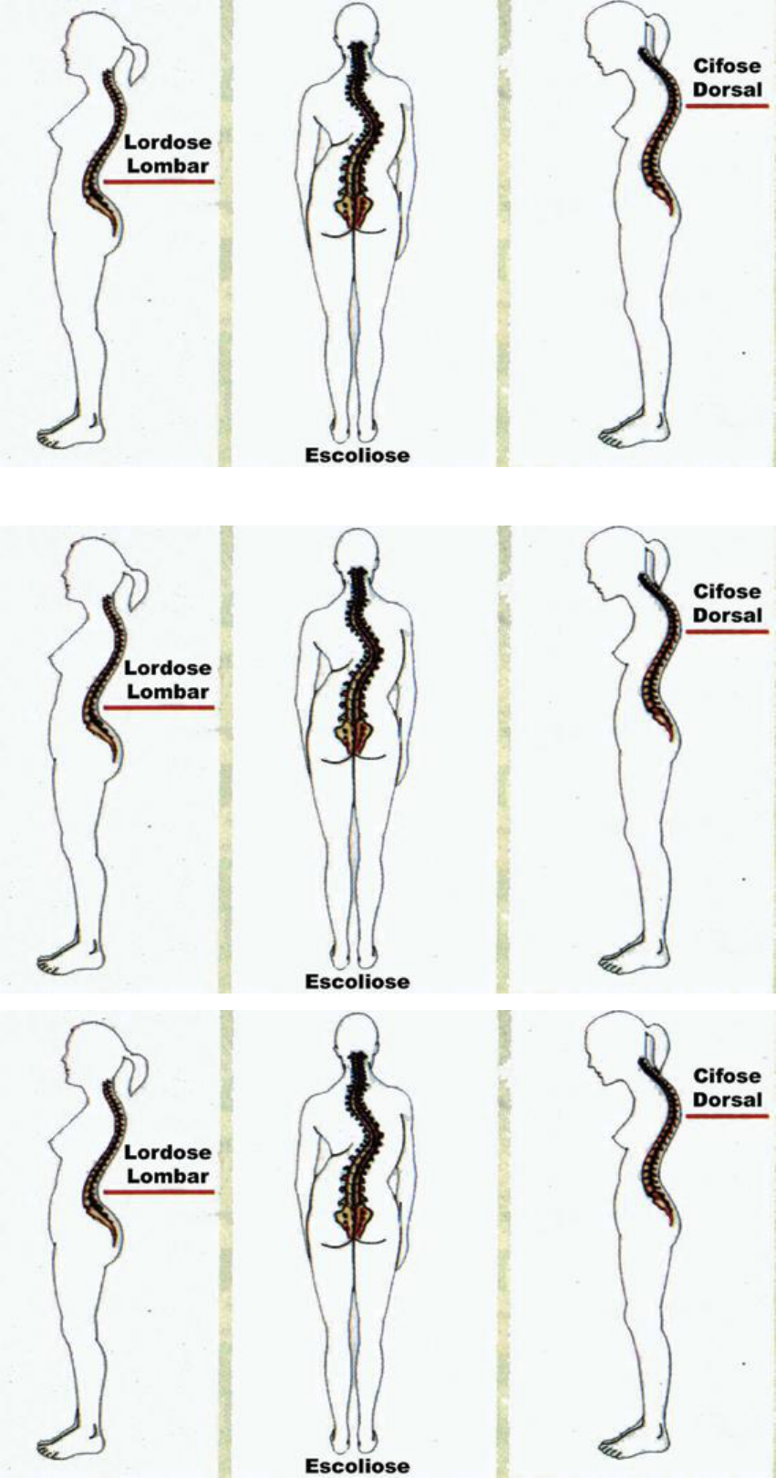 lordose - Educação Física