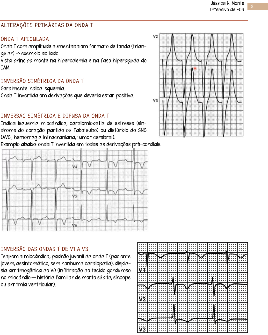 SEGMENTO ST, ONDA T E ONDA U - ELETROCARDIOGRAMA (ECG) - Cardiologia I