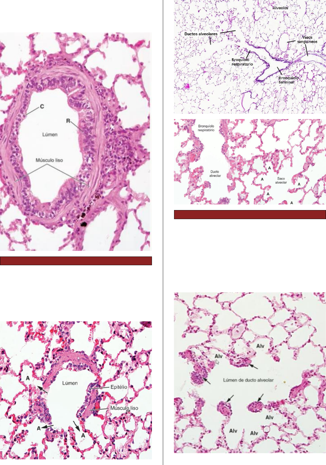 Histologia Do Edema Pulmonar Anatpat UNICAMP
