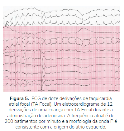 Taquicardia Atrial Focal - Cardiologia I