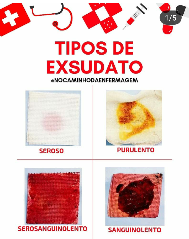 Tipos de exsudatos - Semiologia Médica