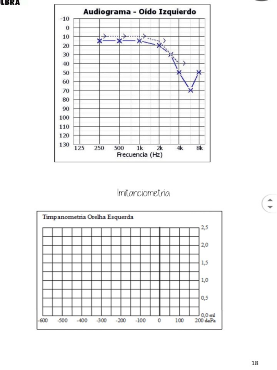 exemplos auiometria e timpanometria - Audiologia