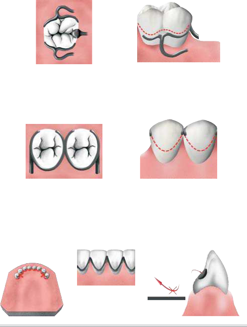 ppr-frank-kaiser - Prótese