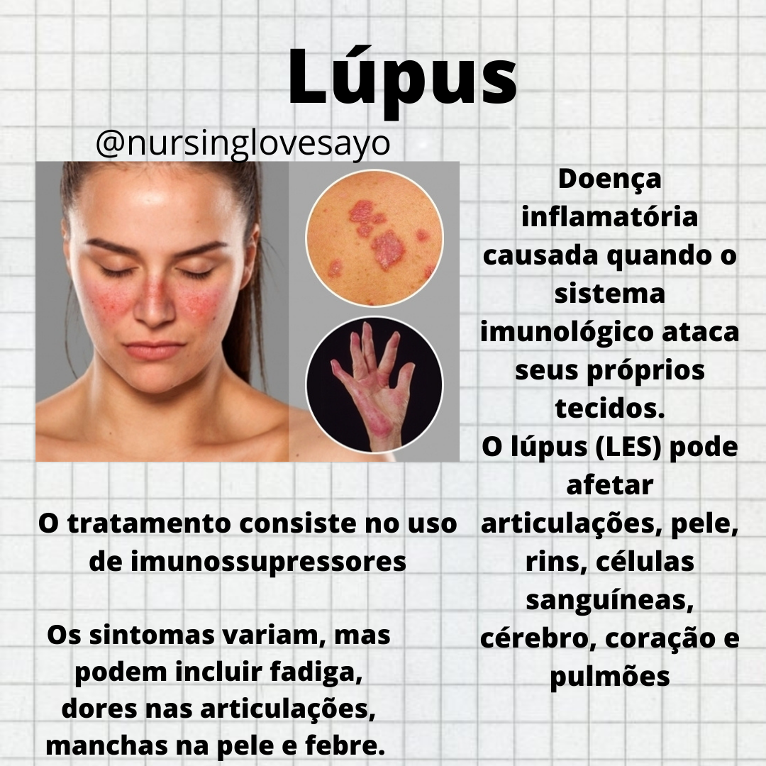 Lúpus - Resumo Medicina