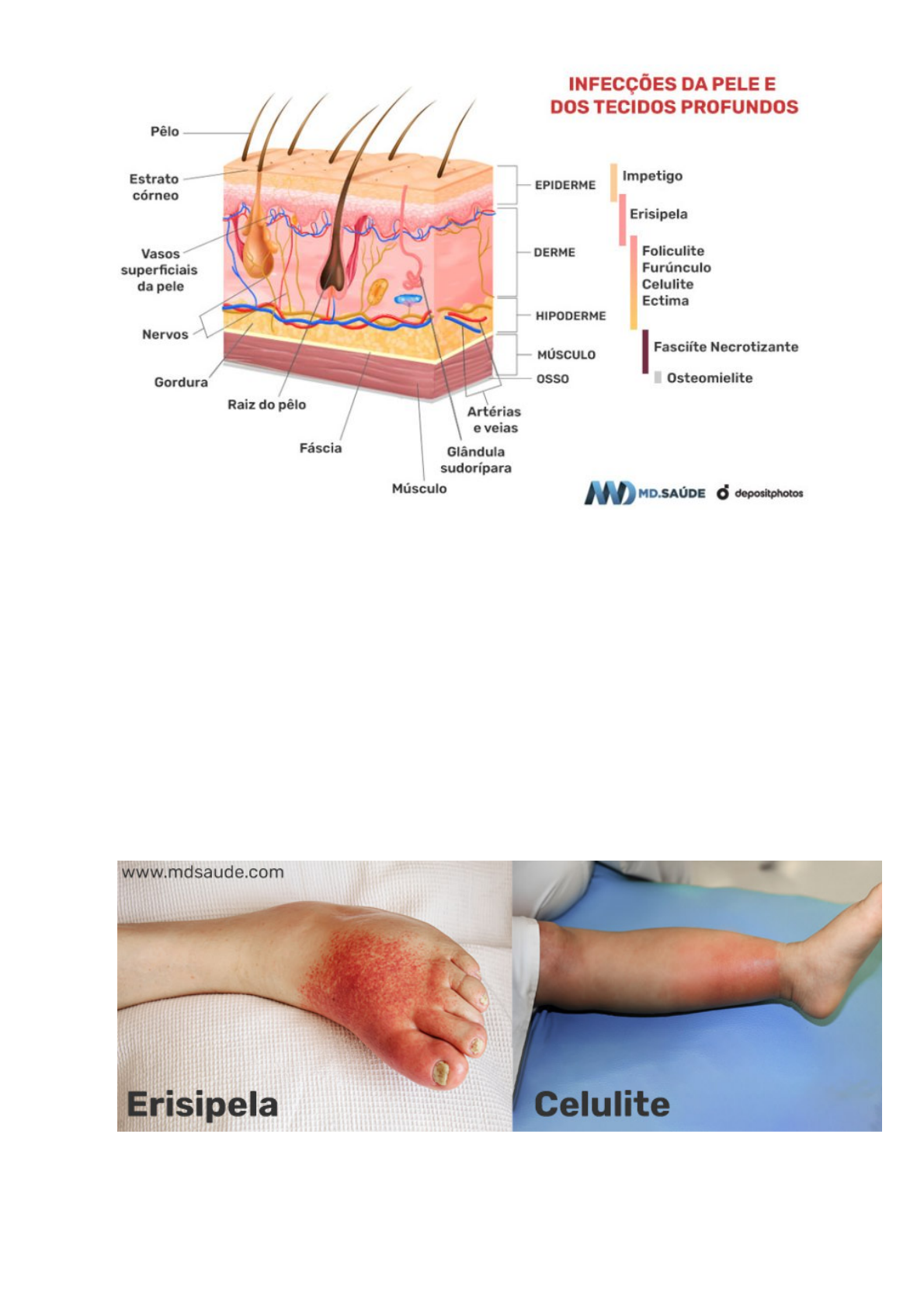 Celulite Perianal Celulite Infecciosa O Que é Sintomas E Tratamento