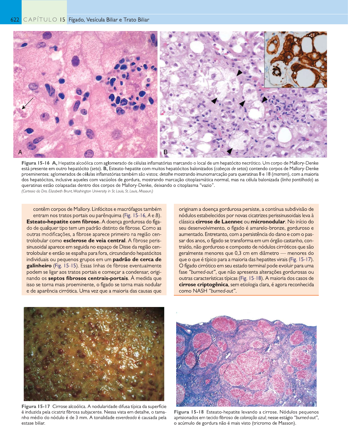 Esteatose hepática alcoólica e não alcoólica - Patologia I