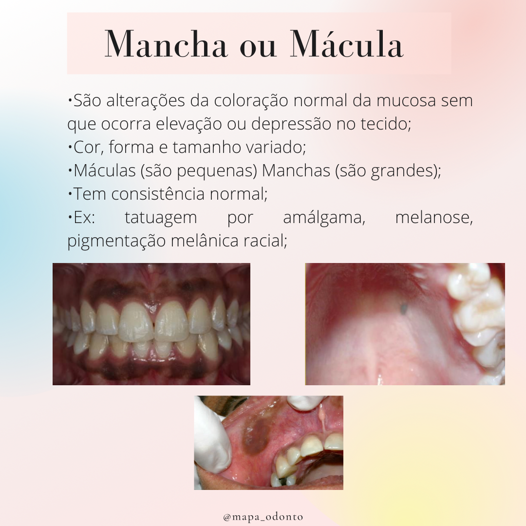 Mancha ou mácula - Estomatologia