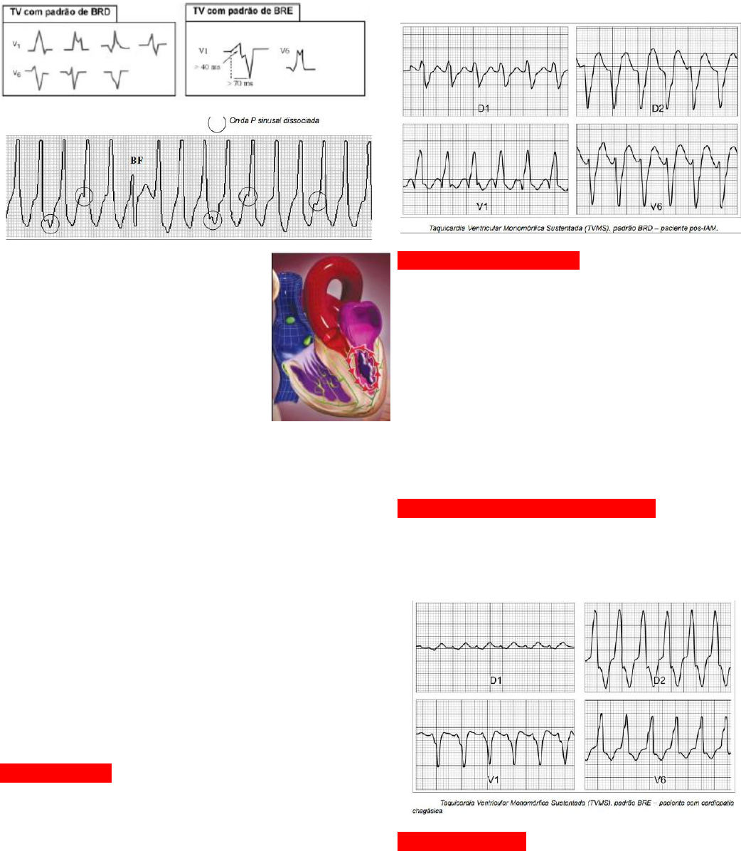 Contracoes Ventriculares Prematuras Trigeminismo Arritmias Cardíacas: