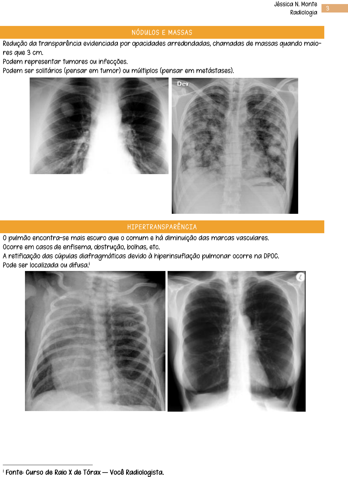 PADRÕES DE ALTERAÇÕES NO RAIO X DE TÓRAX - Radiologia