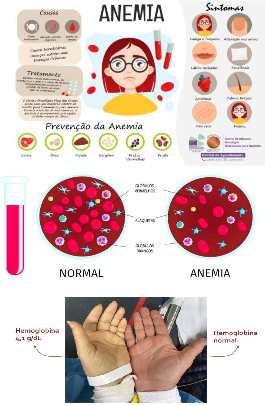 Anemia: o que é, tipos, causas e sintomas