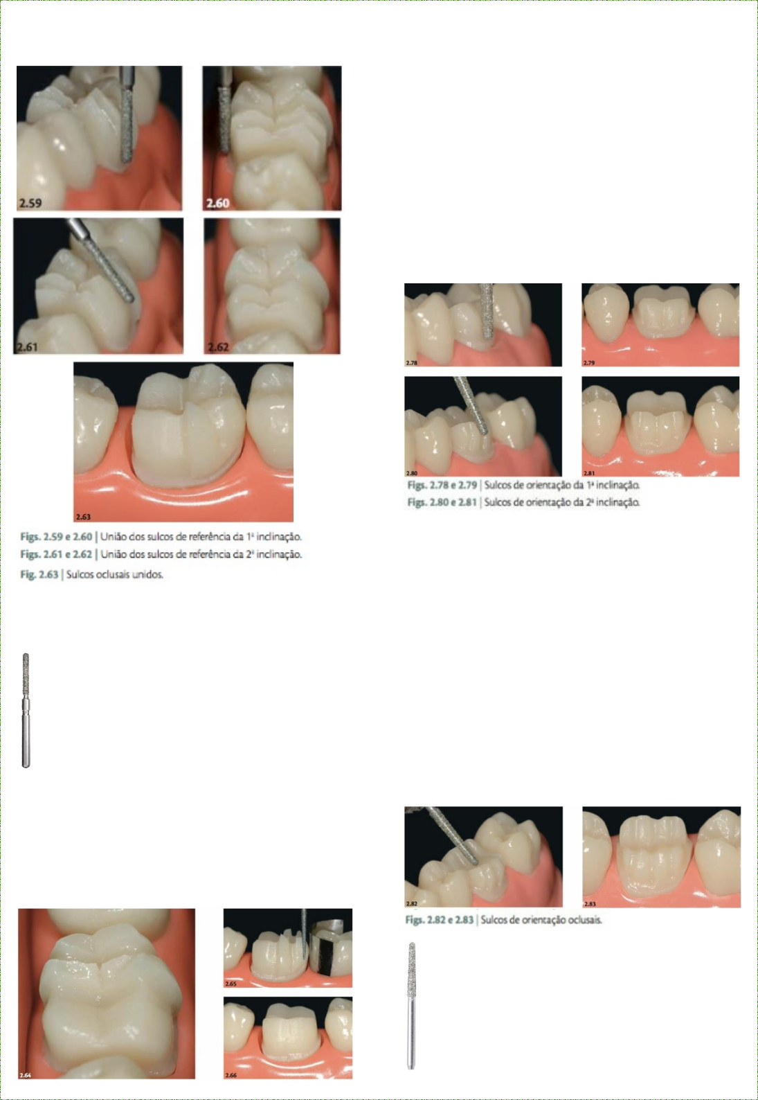 Protese fixa: Preparo para coroa metaloceramica dente posterior ...