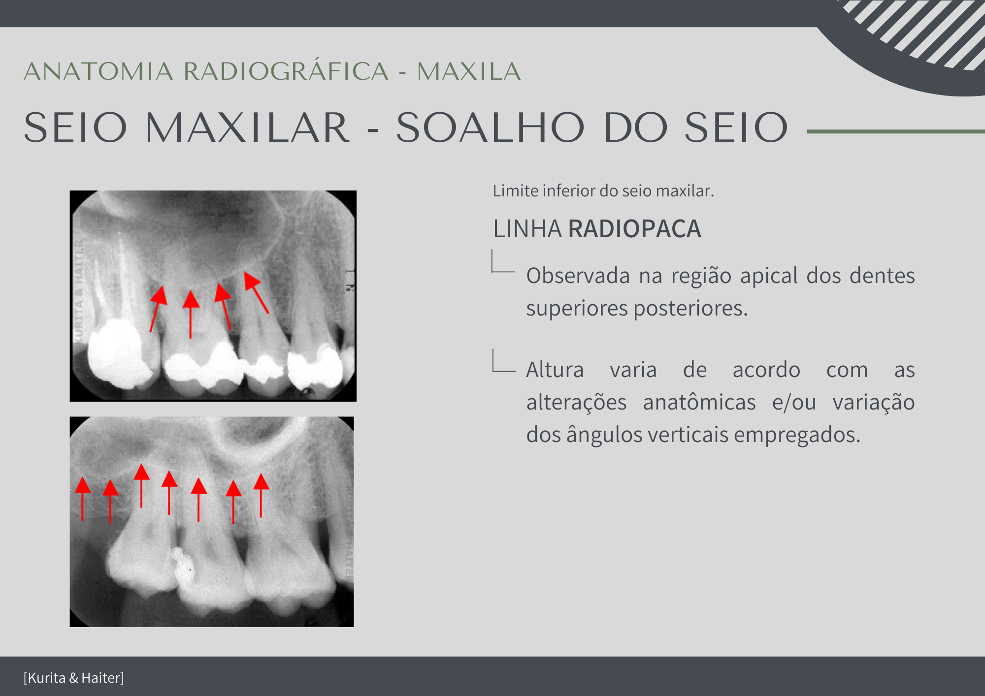 Anatomaia Radiográfica - Soalho do Seio Maxilar - Radiologia Odontológica