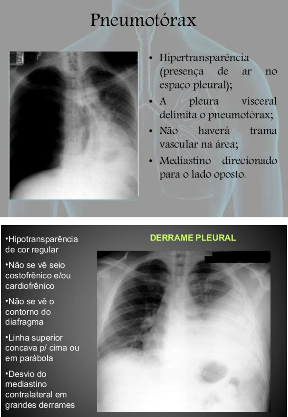 Rx de toráx das doenças - Fisioterapia Respiratória