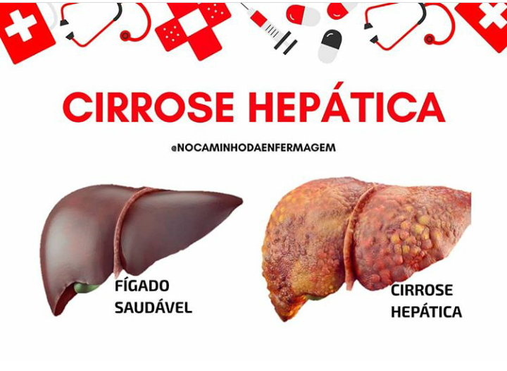 cirrose hepática - Mapa Mental