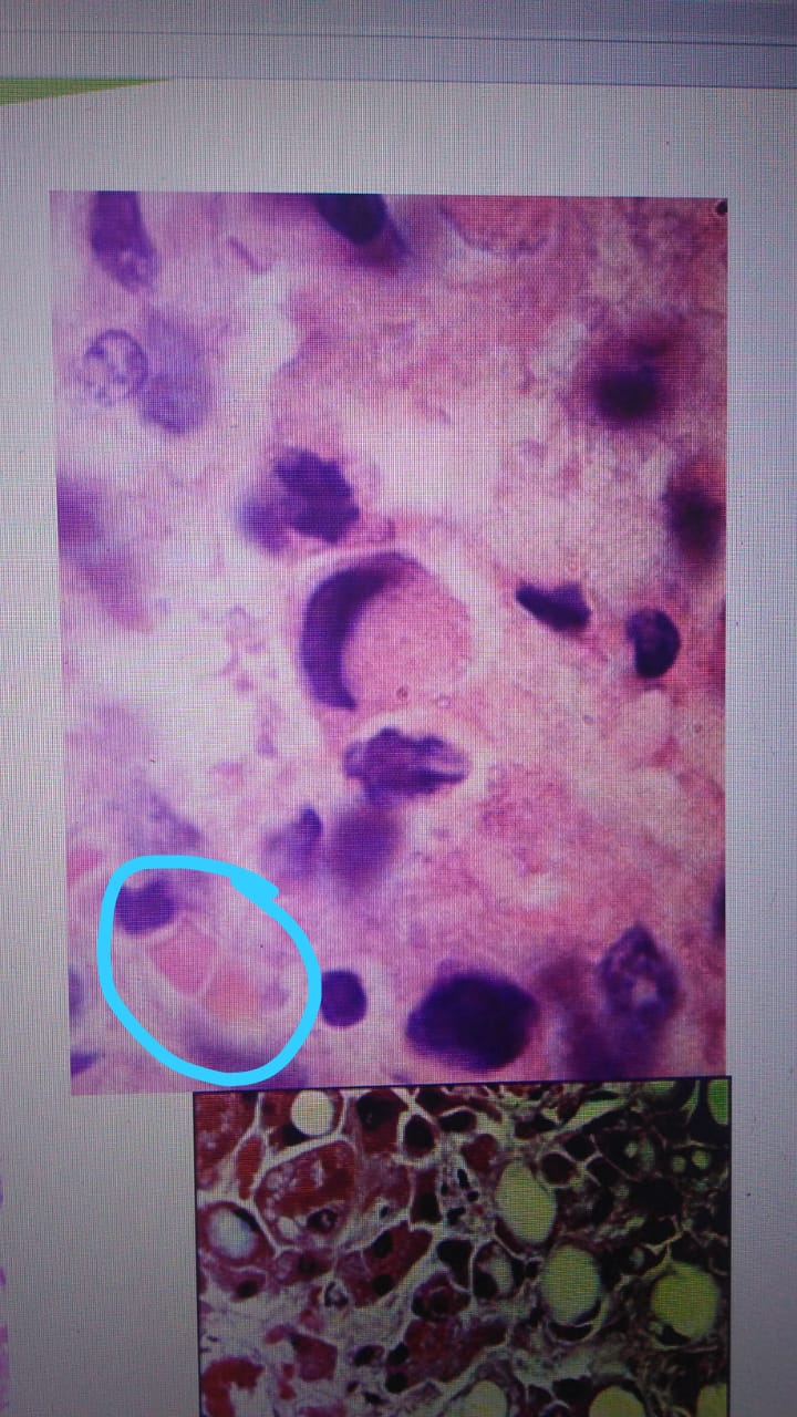 degeneração mucoide - Patologia I