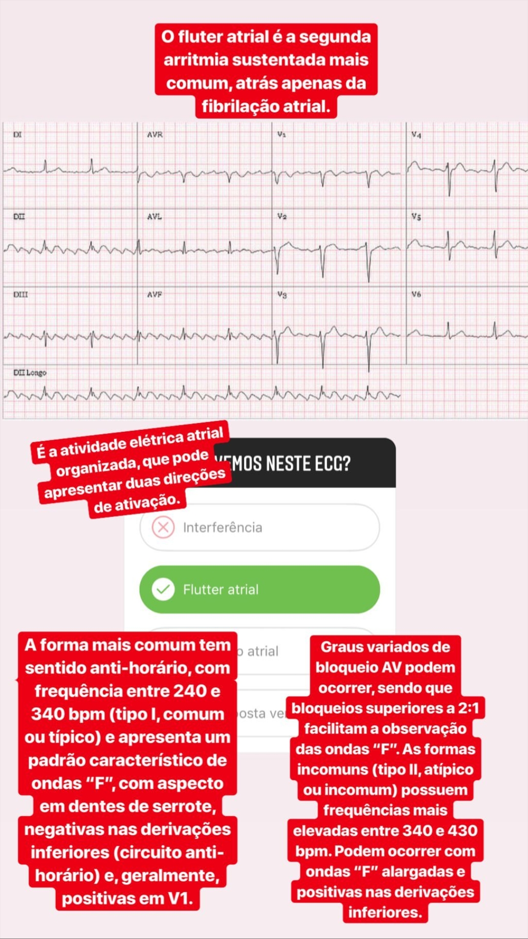 Flutter atrial - Clínica Médica I