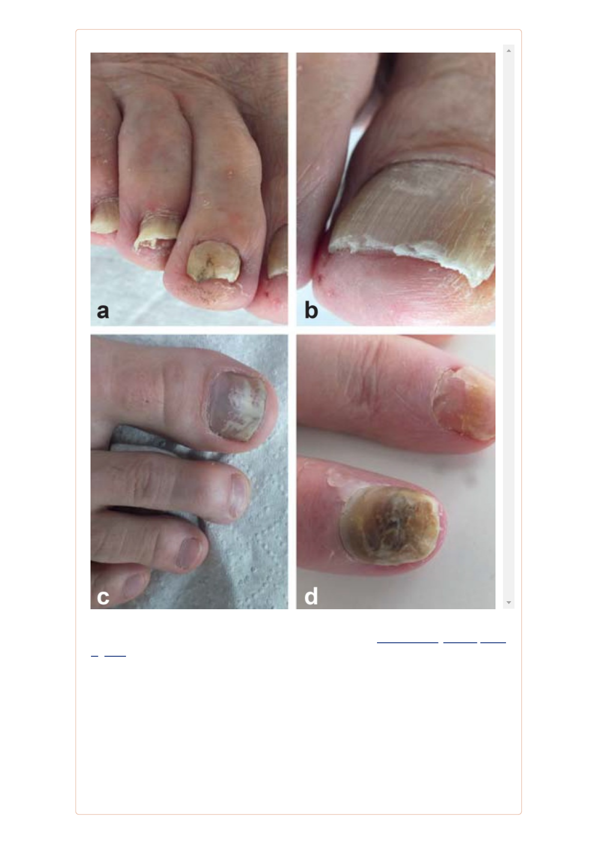 Onicomicose Endonix UNIVERSIDADE FEDERAL DE UBERLÂNDIA PROGRAMA DE