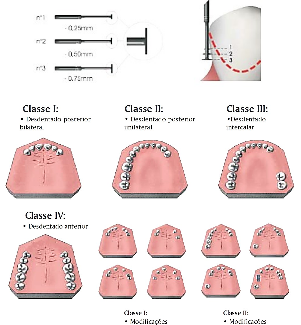Protese Ppr Com Grampo - RETOEDU