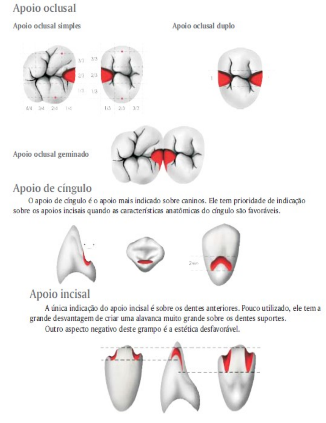 Grampos-PPR - Prótese Removível