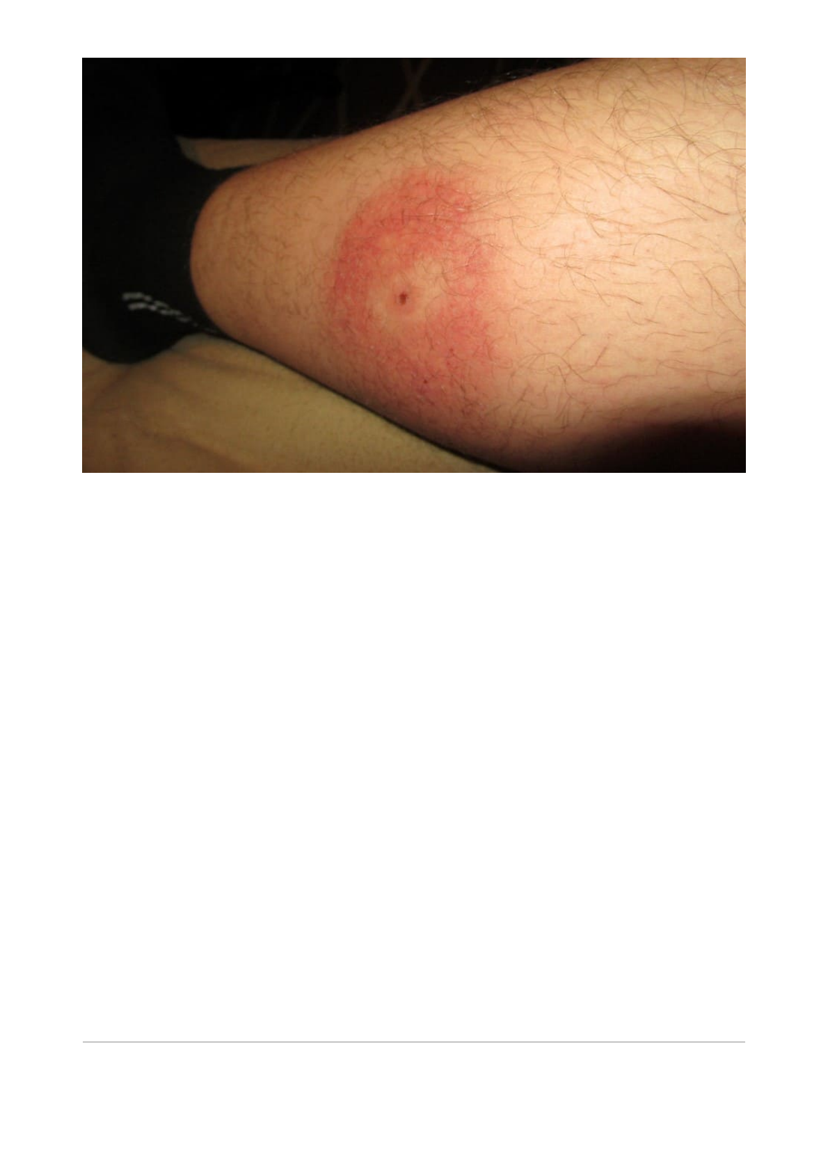 Como tratar picadas de insetos e picadas de aranha - Clínica Médica I