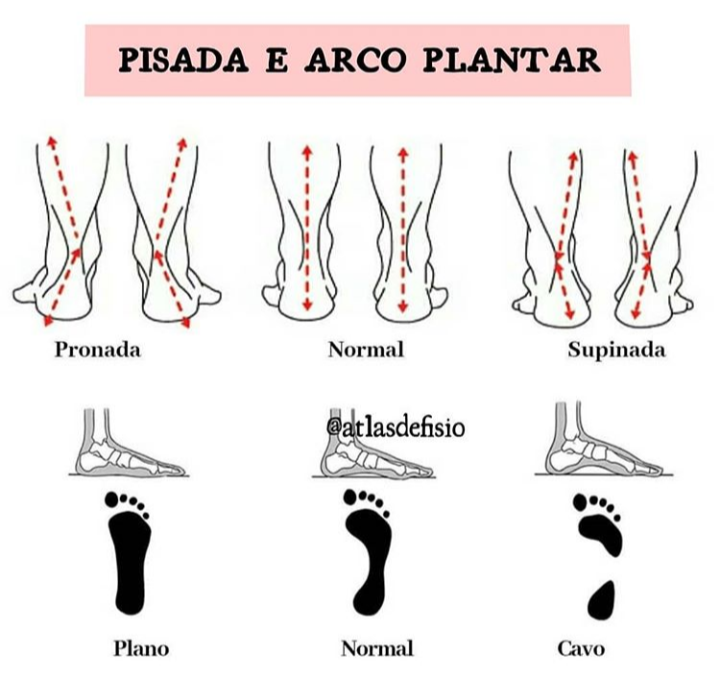 tipos de pisada - Fisioterapia Ortopédica, Traumatol. e Reumatológica ...