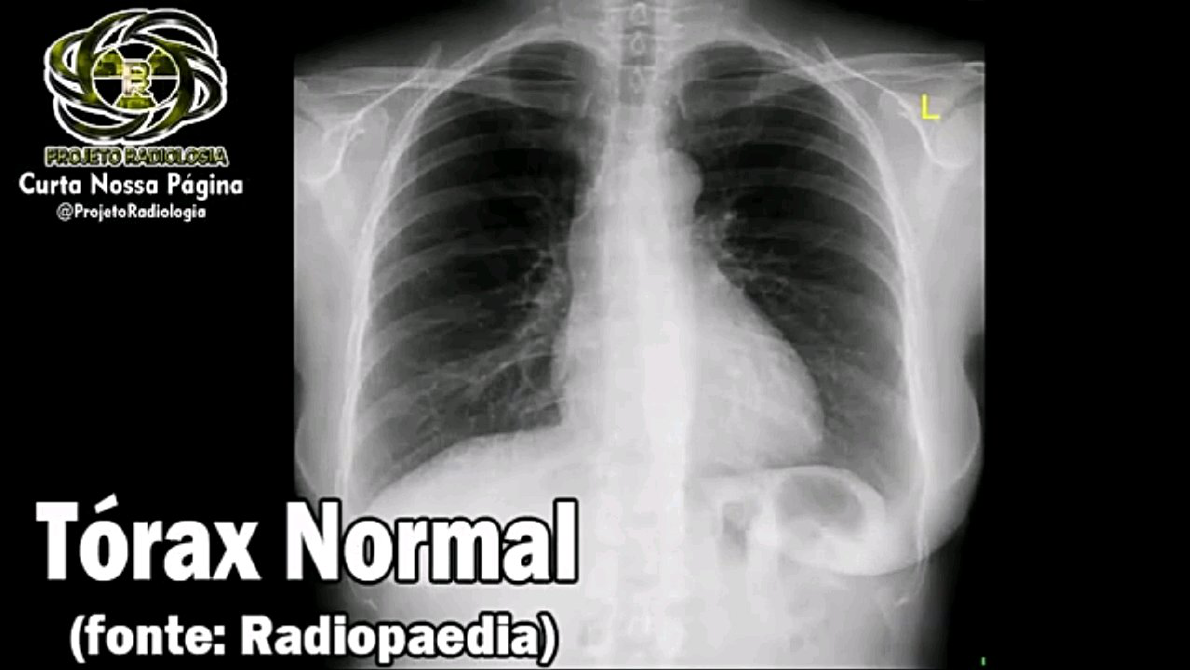 Principais Patologias torax.pdf - Radiologia