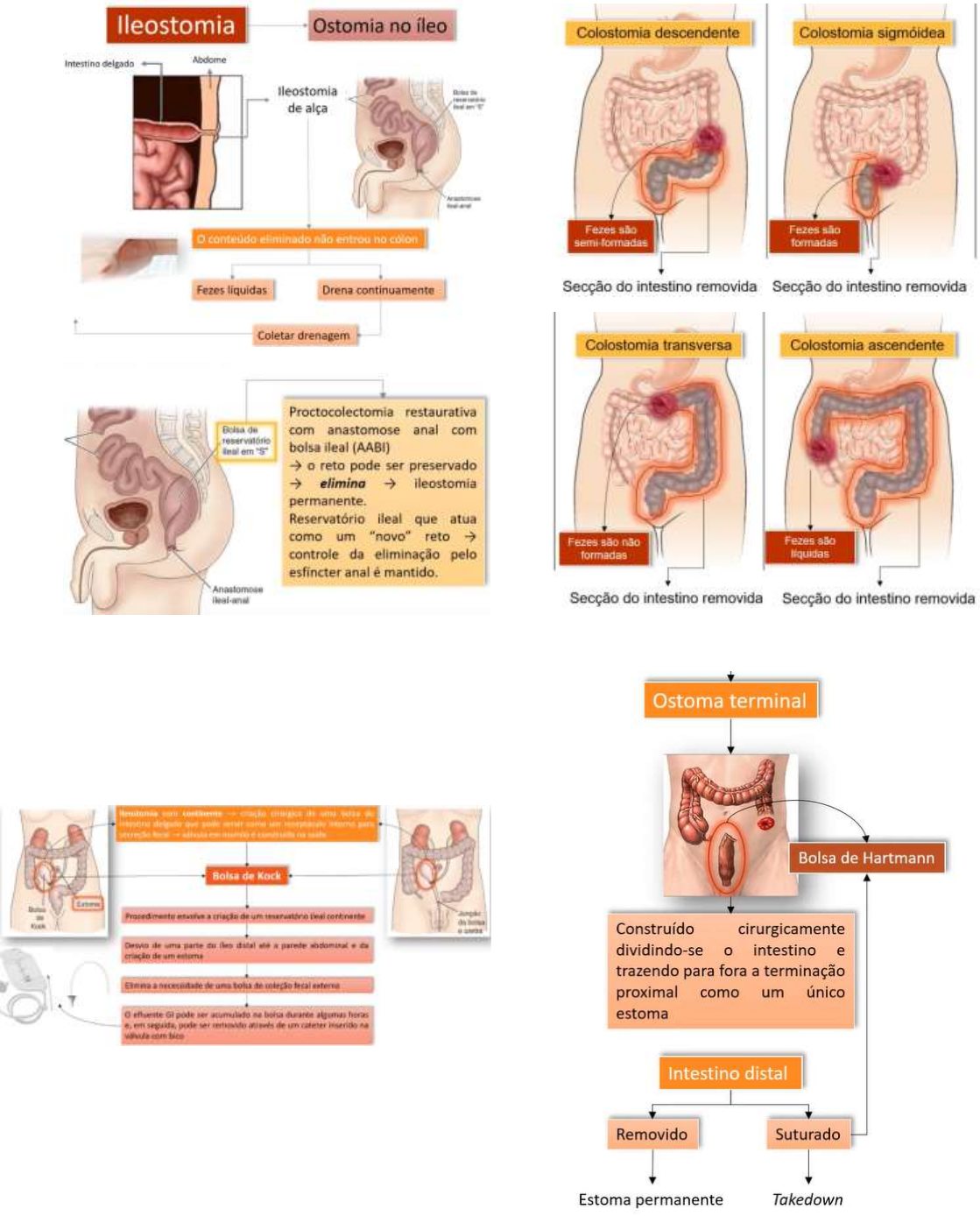 Ileostomia Continente Kock Tecniche Chirurgiche Delle Enterostomie E