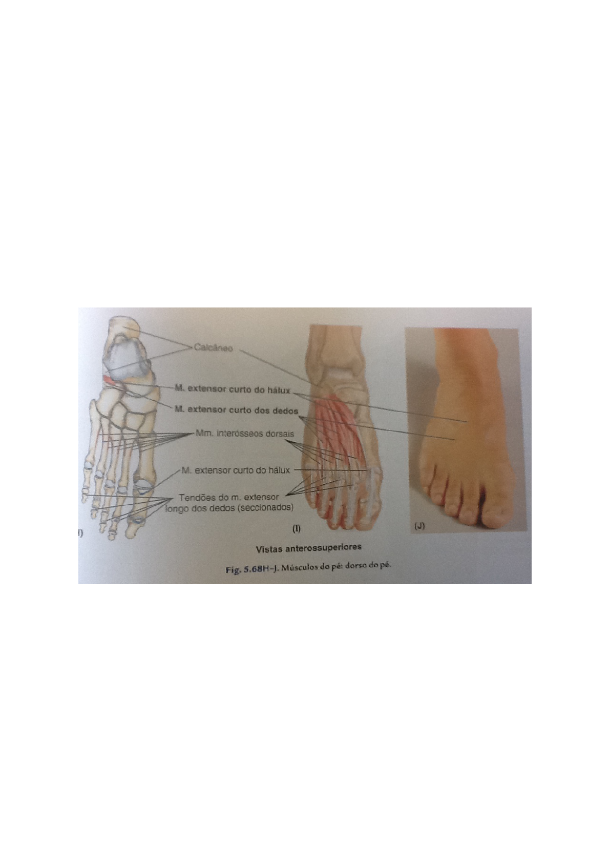 Extensor Curto Do Halux