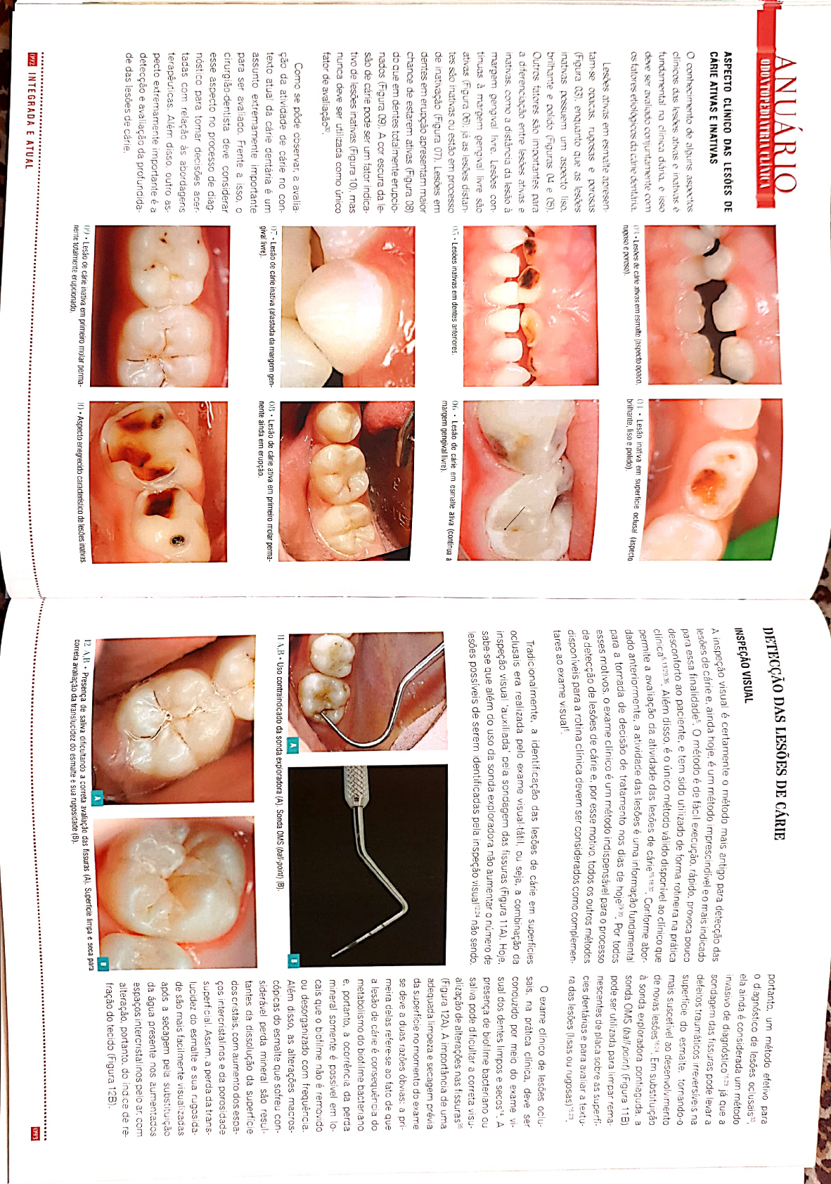 diagnostico da carie em criança - Odontologia