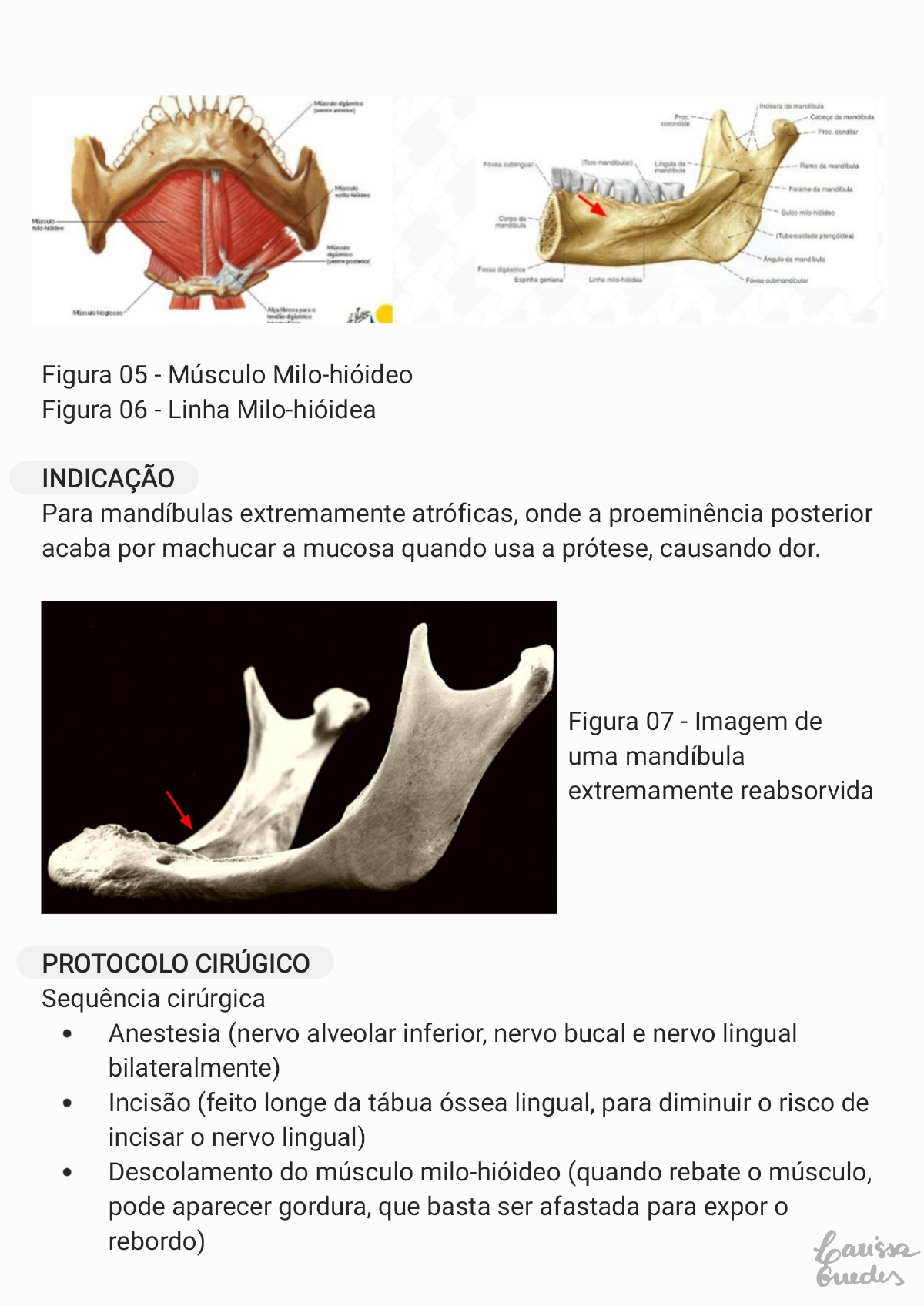 REDUÇÃO DOS TUBÉRCULOS GENIANOS E REMOÇÃO DO REBORDO MILO-HIÓIDEO ...