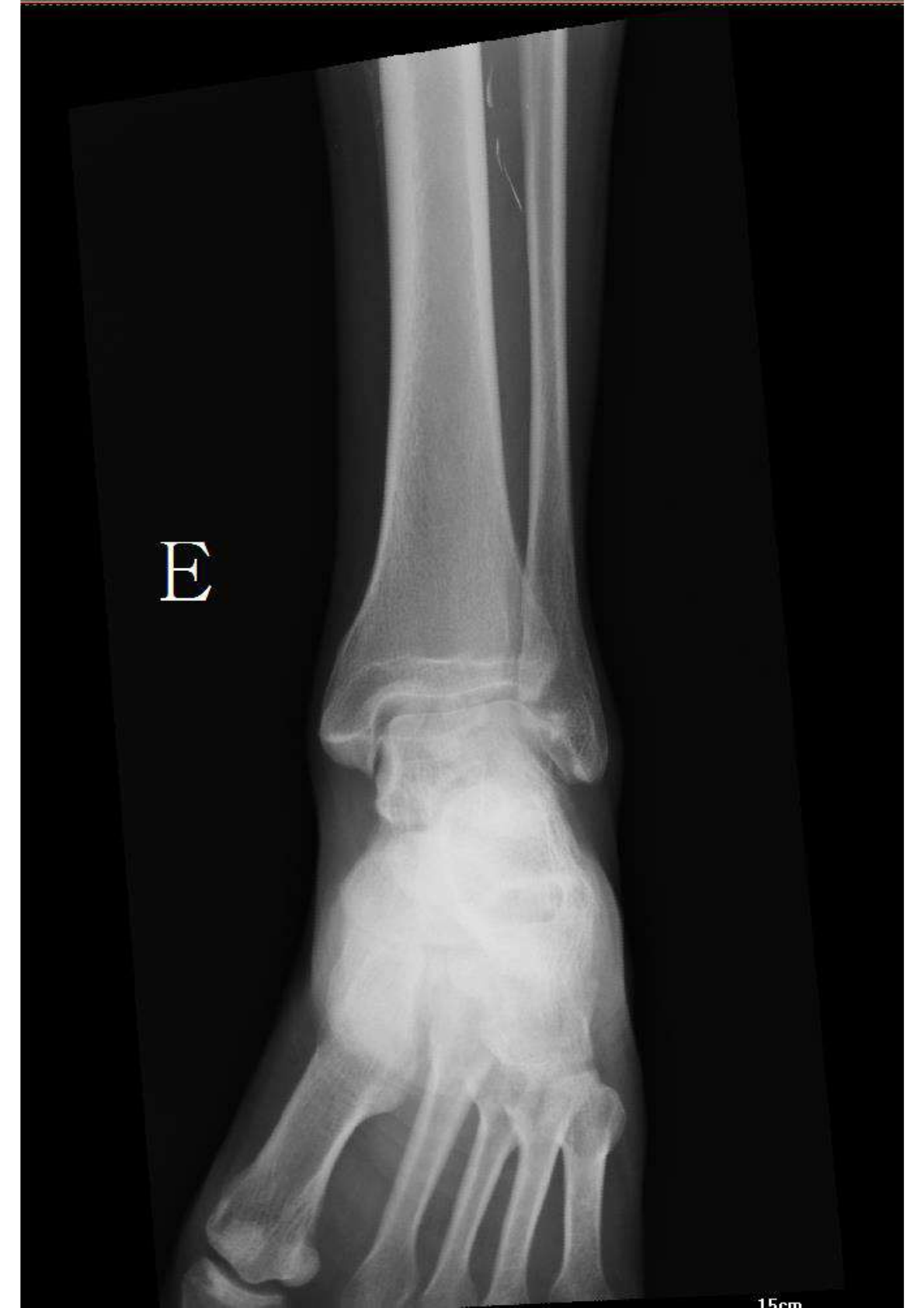 Radiografia Normal Do Tornozelo Esquerdo