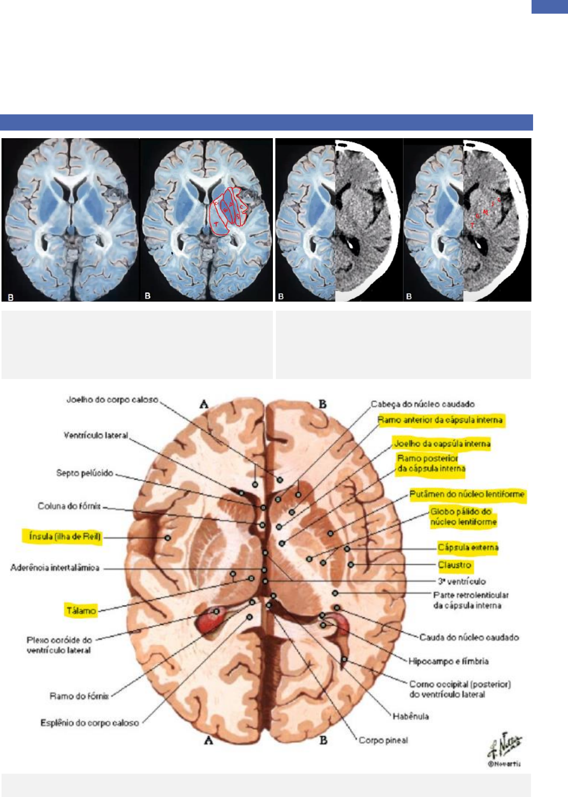 Acidente Vascular Cerebral Lacunar