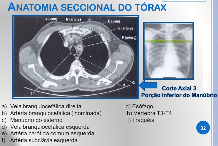 ANATOMIA SECCIONAL DO TÓRAX - Anatomia I