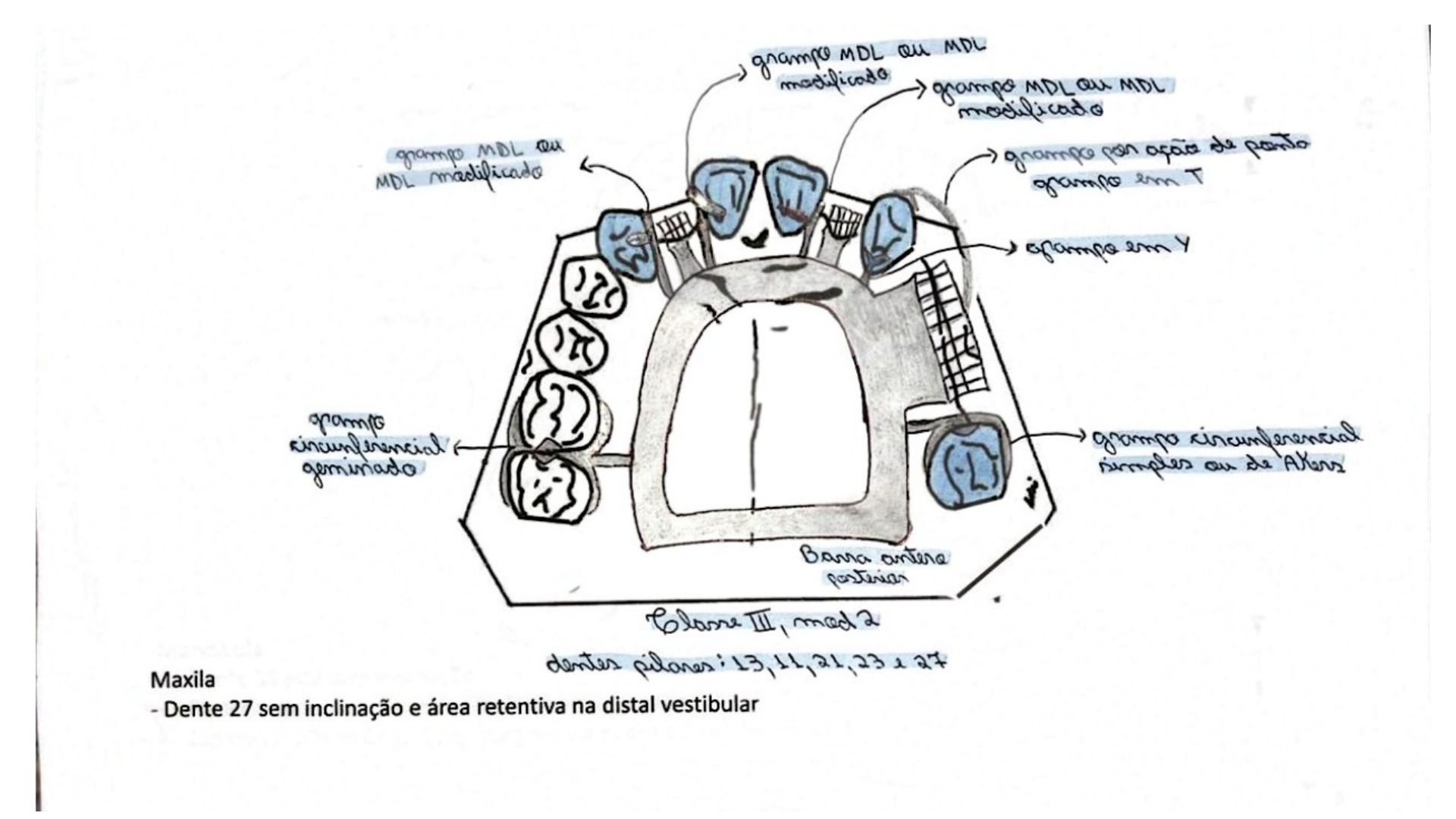 TRABALHO PPR - Protese Parcial Removivel