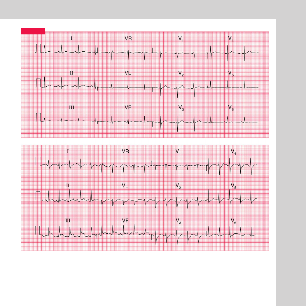 Dr Rawdy - Ejercicios ECG - EJERCICIO 87 - Cardiologia I