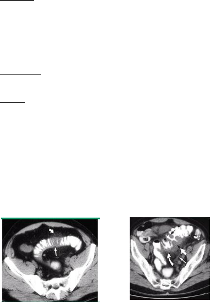 Diverticulite - Gastroenterologia
