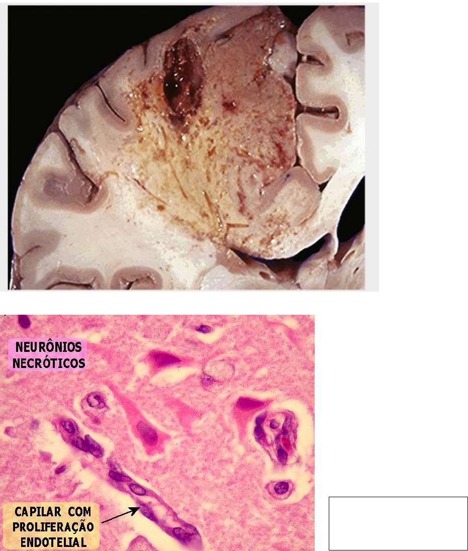 Cerebro De Necrose De Liquefacao Você Sabe Qual A Diferença Entre Um