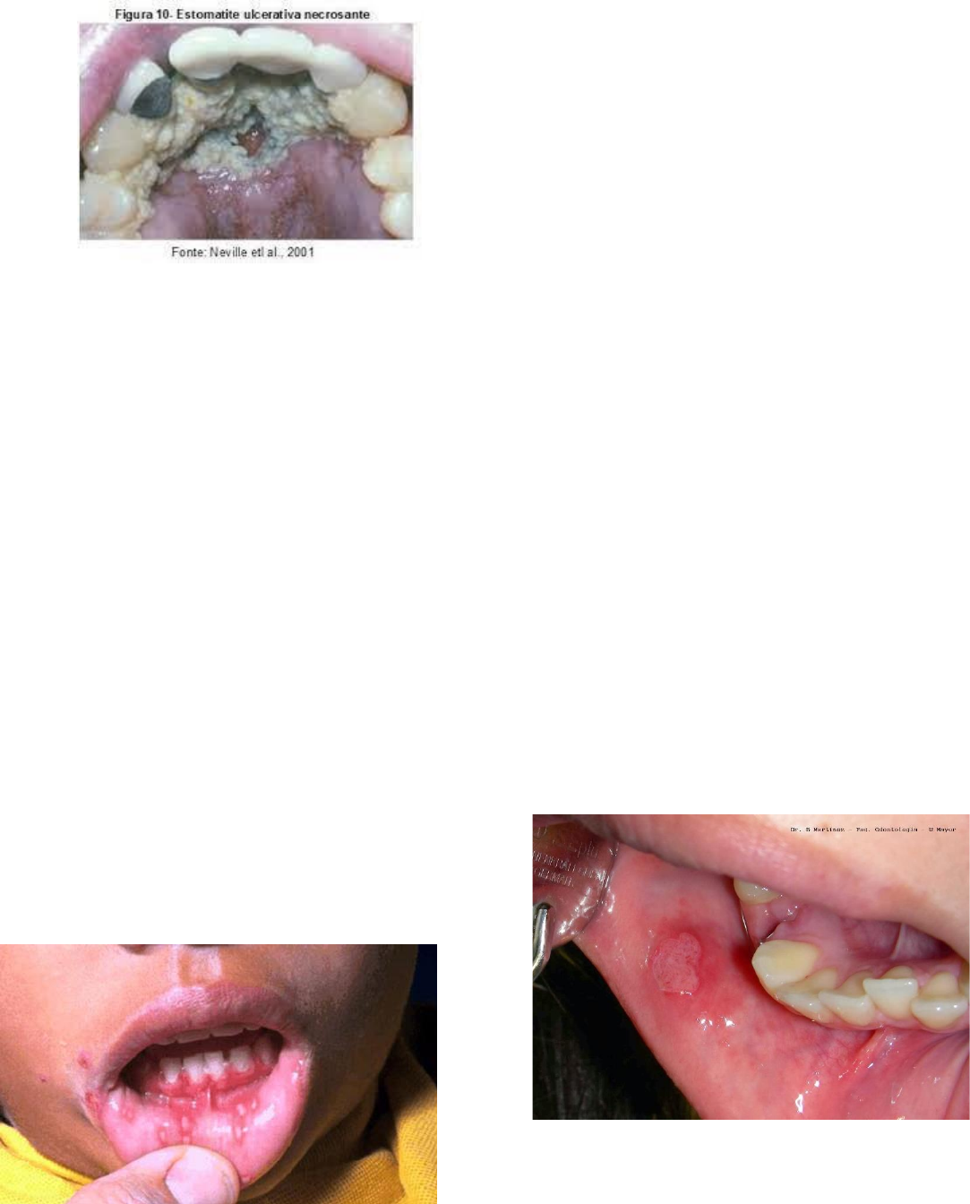 Histologia De Gengivite Ulcerativa Necrosante