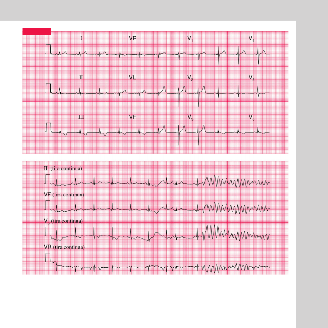 Dr Rawdy - Ejercicios ECG - EJERCICIO 147 - Cardiologia I