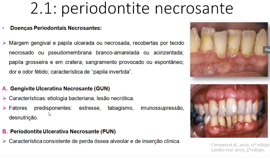 Histologia De Gengivite Ulcerativa Necrosante