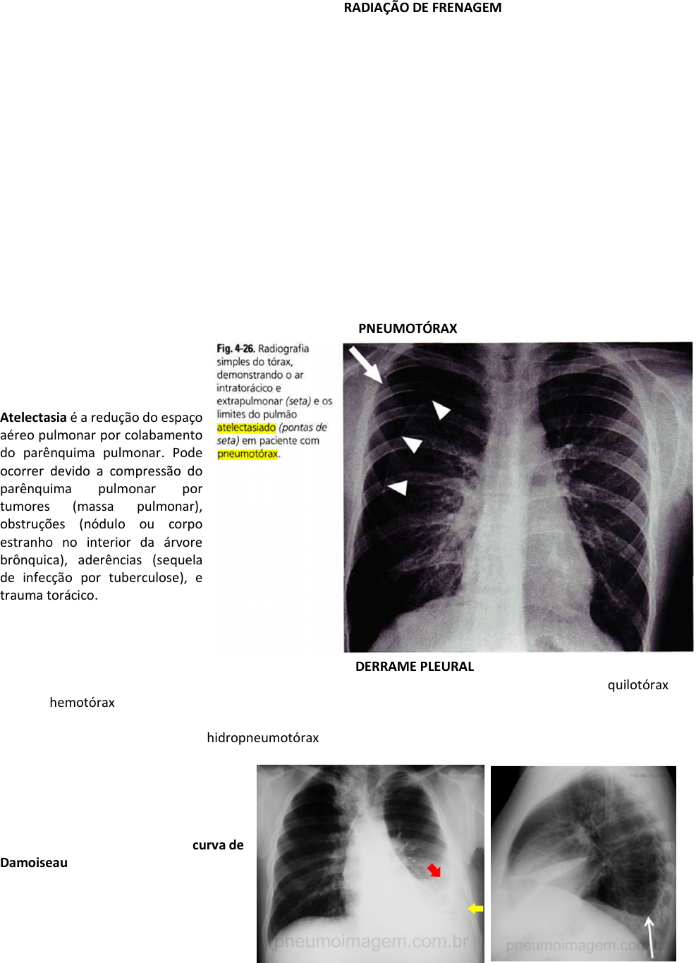 Raio X De Atelectasia RESUMO P1 RADIOLOGIA Imagem Médica