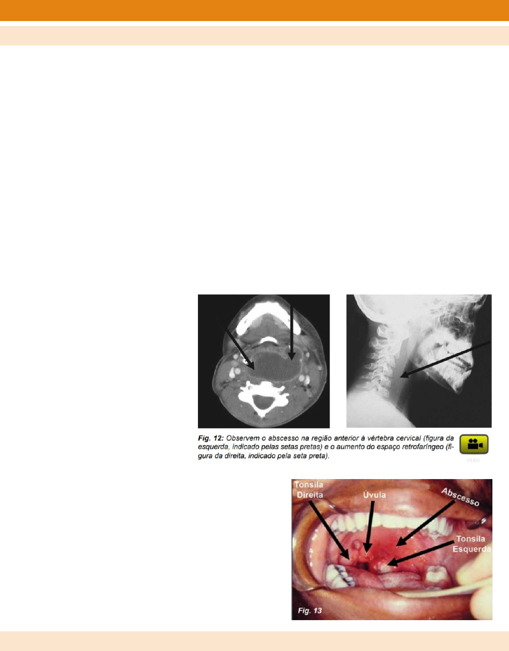Abscesso Retrofaringeo Em Criancas