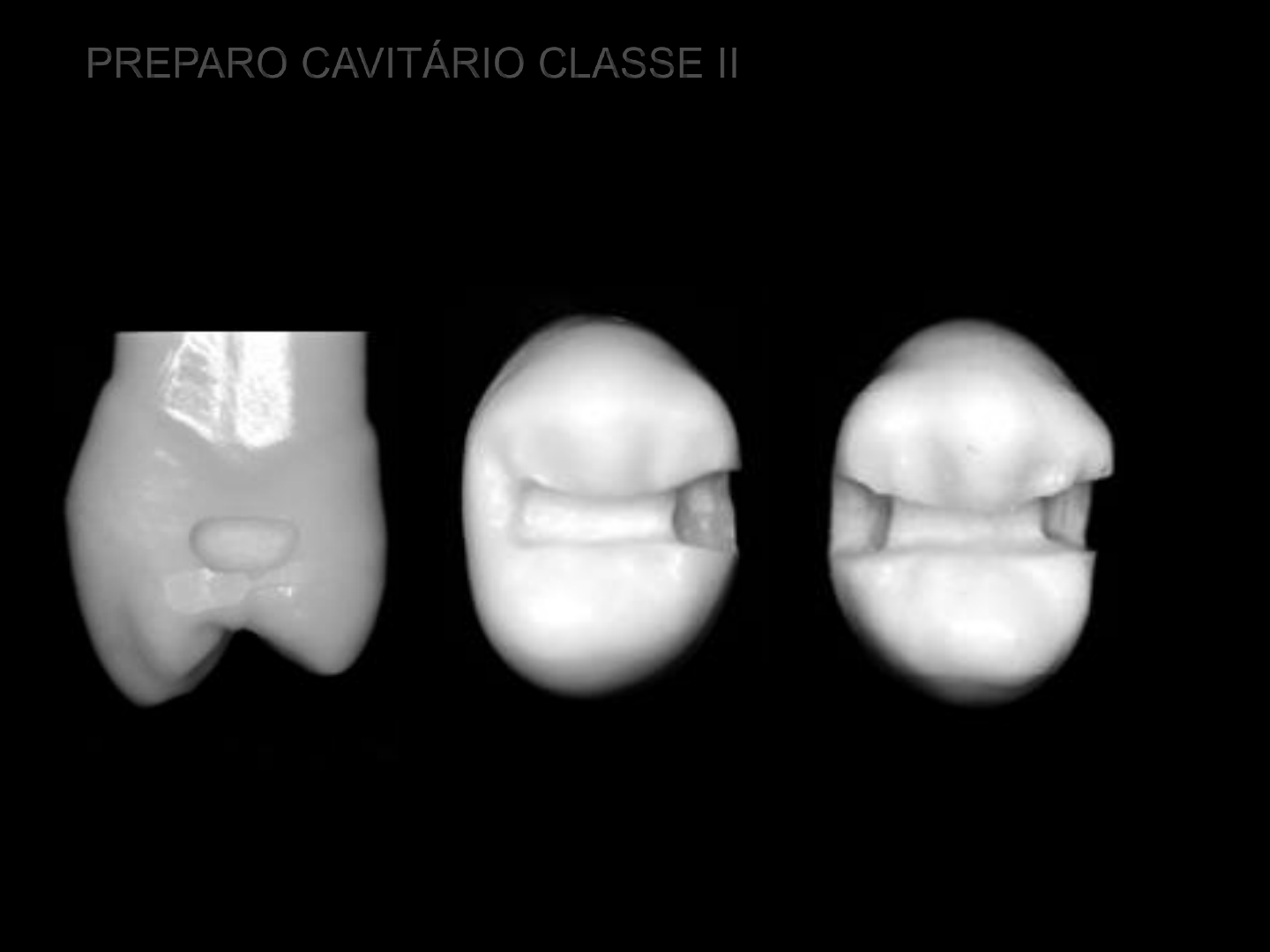 Preparo Cavitario Classe 2 - RETOEDU