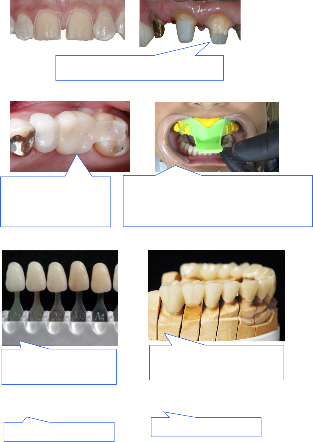 PRÓTESE FIXA 01 - Prótese Fixa